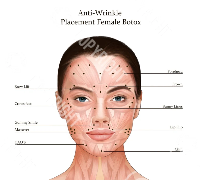 How Often Should You Get Botox? Expert Tips for a Wrinkle-Free Look ...